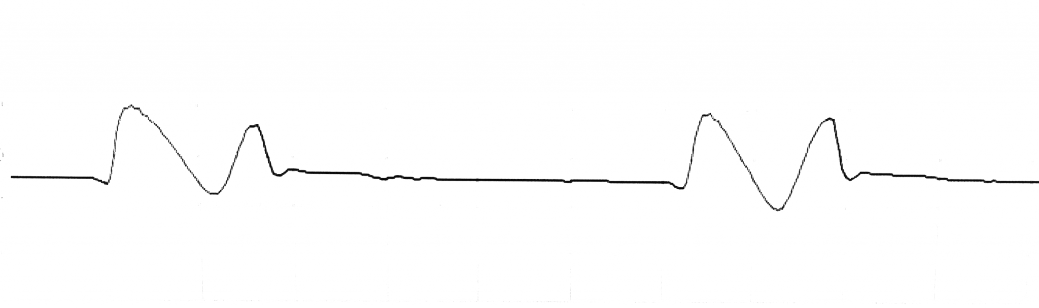 Episode 10: Ventilator dyssynchrony – Critical Care Scenarios